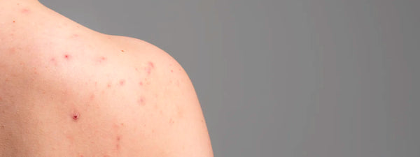 How Do Scars Form? - RecoverX Skincare