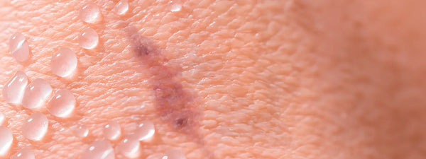 Silicone Based Scar Treatments: An Overview - RecoverX Skincare