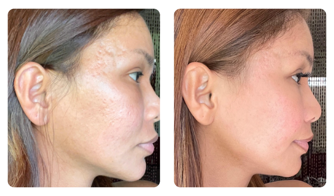 RecoverX Before and Afters - RecoverX Skincare