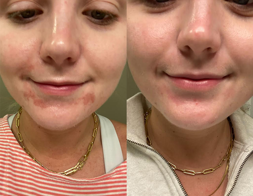 RecoverX Before and Afters - RecoverX Skincare